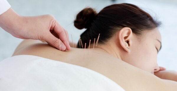 Acupuncture Physiotherapy - Physiobic Healthcare : Physiotherapy At ...